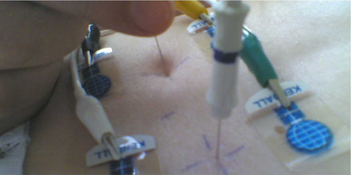 Electromyography (EMG) - Capital Diagnostic Centre